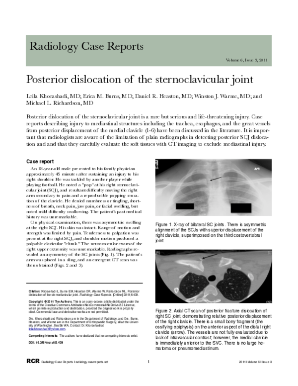 (PDF) Posterior dislocation of the sternoclavicular joint
