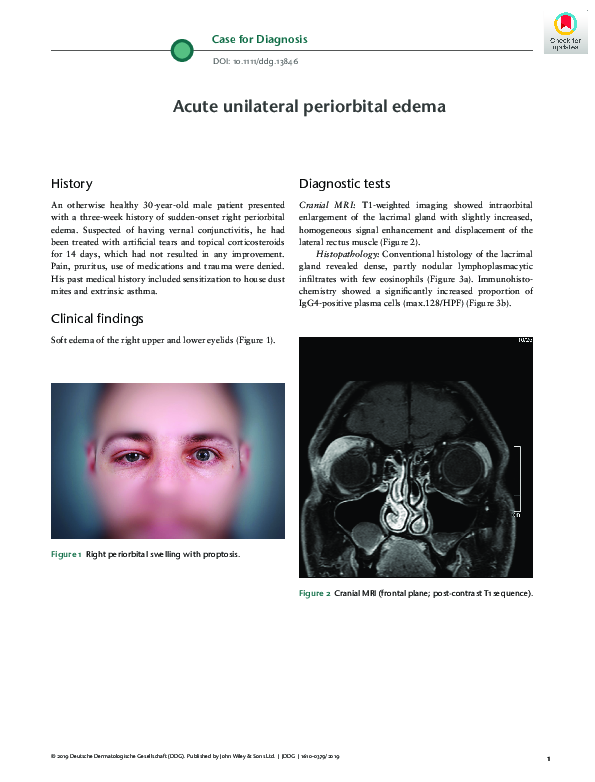 (PDF) Acute unilateral periorbital edema