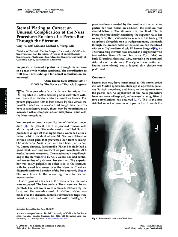 (PDF) Sternal Plating to Correct an Unusual Complication of the Nuss ...