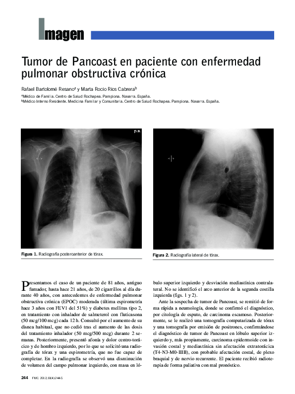 (PDF) Tumor de Pancoast en paciente con enfermedad pulmonar obstructiva ...