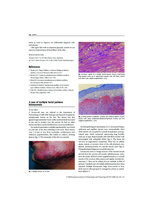 (PDF) A case of multiple facial painless leiomyomata | Ilknur K I V A N ...