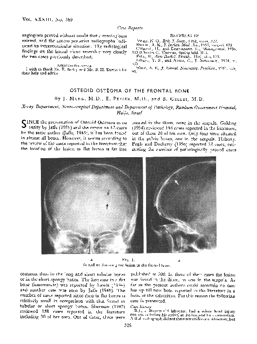 (PDF) Osteoid Osteoma of the Frontal Bone