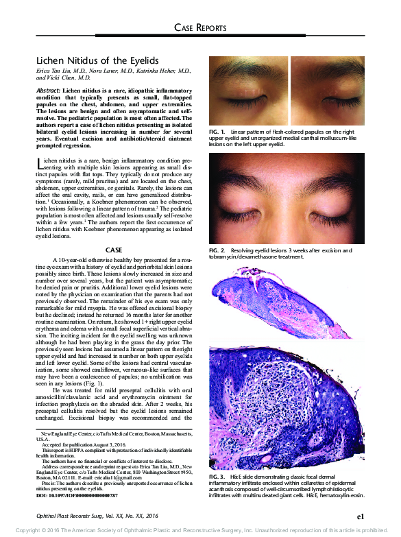(PDF) Lichen Nitidus of the Eyelids