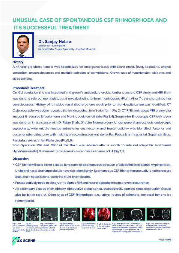 (PDF) UNUSUAL CASE OF SPONTANEOUS CSF RHINORRHOEA AND ITS SUCCESSFUL ...