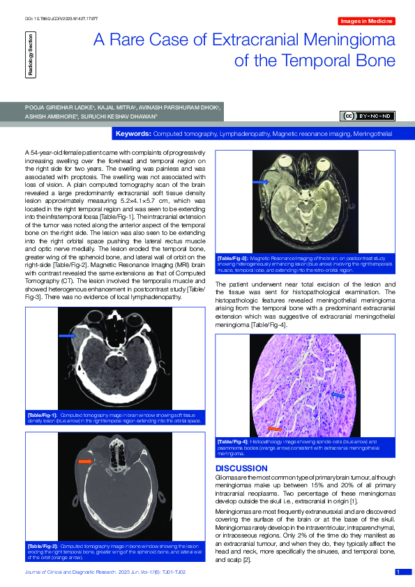 (PDF) A Rare Case of Extracranial Meningioma of the Temporal Bone