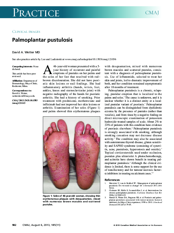 (PDF) Palmoplantar pustulosis