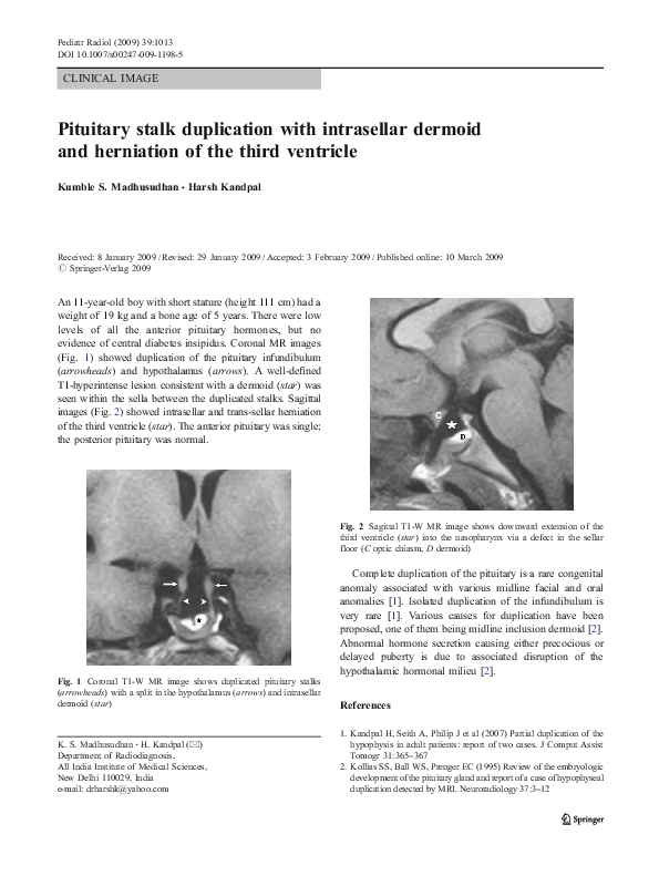(PDF) Pituitary stalk duplication with intrasellar dermoid and ...