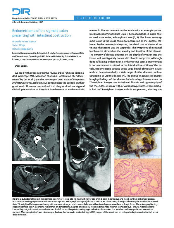 (PDF) Endometrioma of the sigmoid colon presenting with intestinal ...