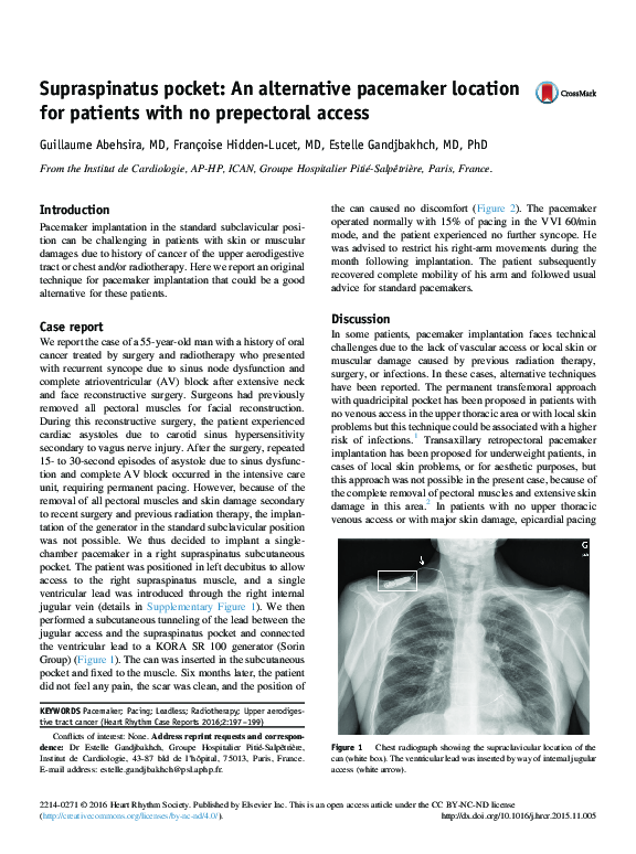 (PDF) Supraspinatus Pocket: An Alternative Pacemaker Location for ...