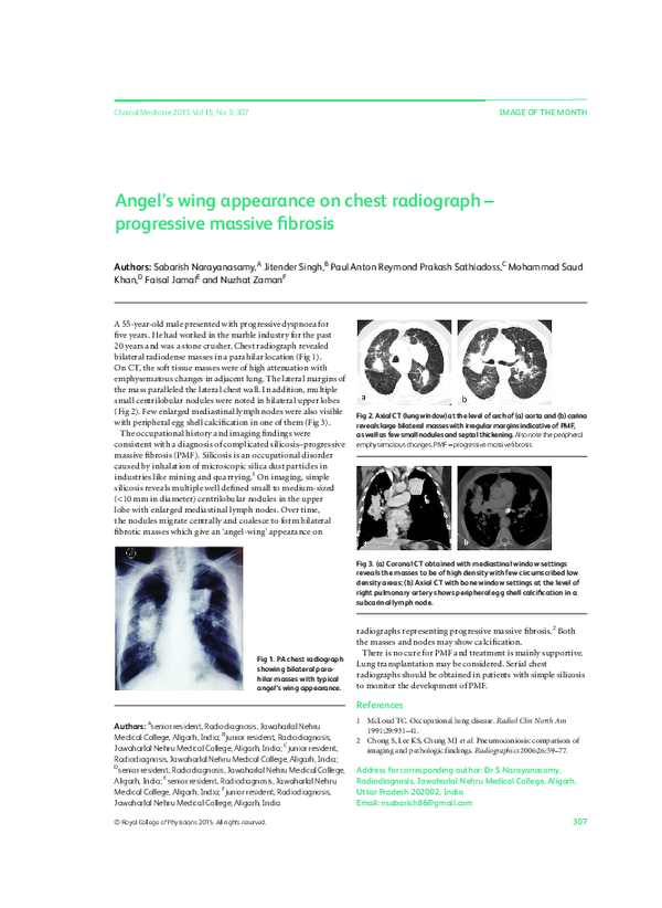 (PDF) Angel's wing appearance on chest radiograph - progressive massive ...