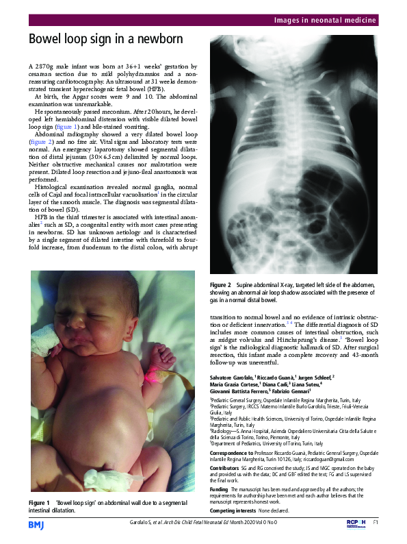 (PDF) Bowel loop sign in a newborn | Jürgen Schleef - Academia.edu