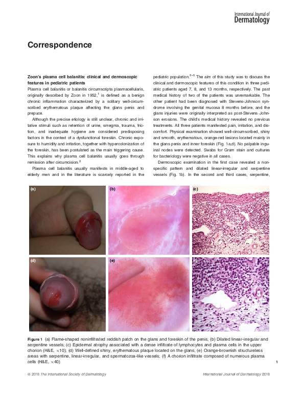 (PDF) Zoon's plasma cell balanitis: clinical and dermoscopic features ...