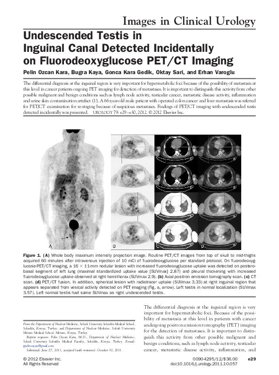 (PDF) Undescended Testis in Inguinal Canal Detected Incidentally on ...