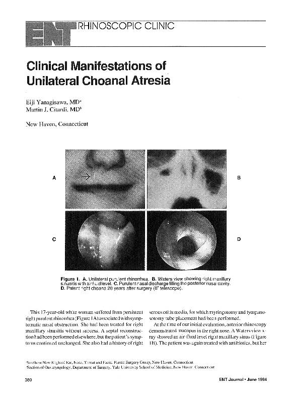 (PDF) Clinical Manifestations of Unilateral Choanal Atresia