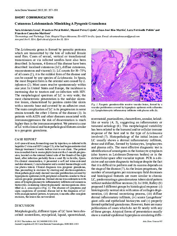 (PDF) Cutaneous Leishmaniasis Mimicking A Pyogenic Granuloma