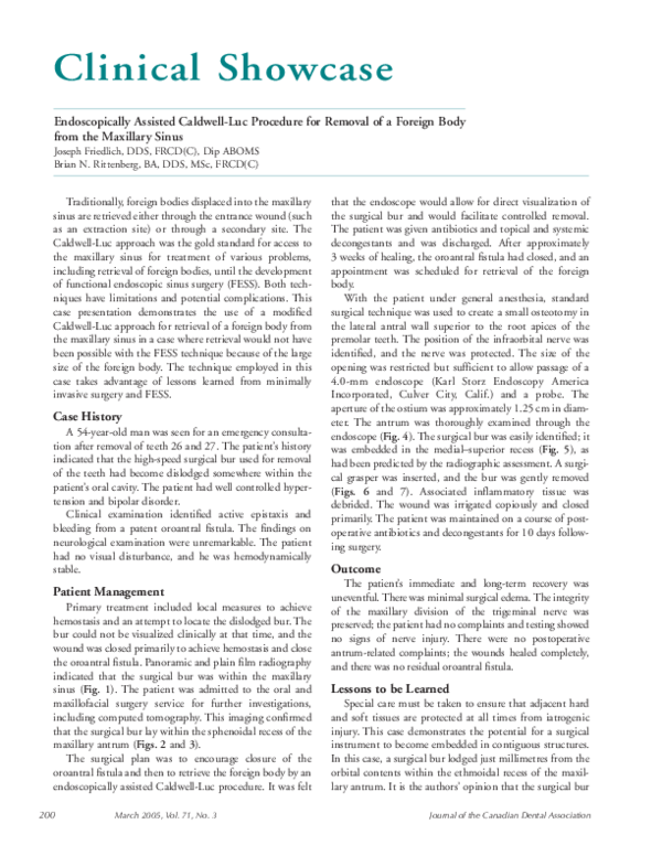 (PDF) Endoscopically assisted Caldwell-Luc procedure for removal of a ...