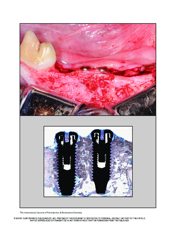 (PDF) Vertical ridge augmentation using an equine block infused with ...