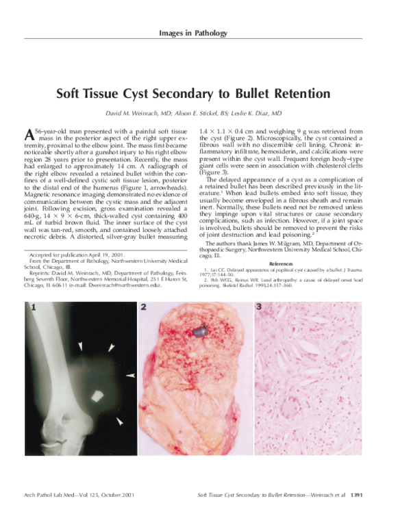 (PDF) Soft Tissue Cyst Secondary to Bullet Retention