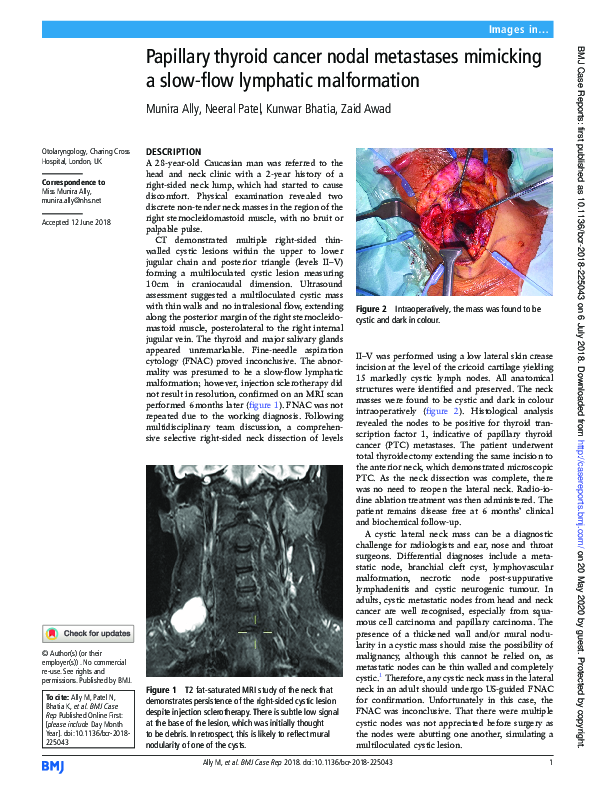 (PDF) Papillary thyroid cancer nodal metastases mimicking a slow-flow lymphatic malformation ...
