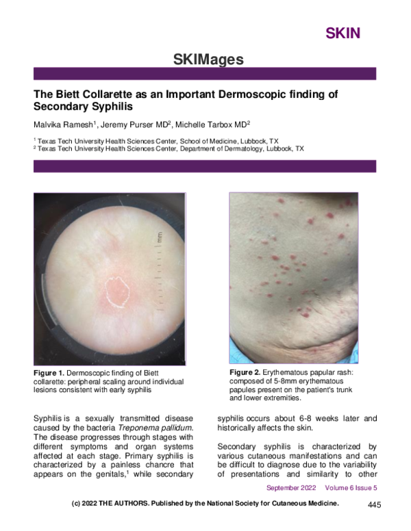 (PDF) The Biett Collarette as an Important Dermascopic Finding of ...