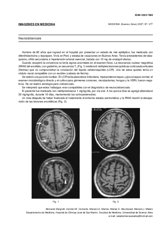 (PDF) Neurocisticercosis