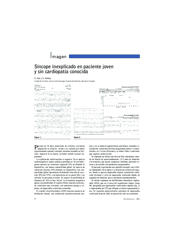 (PDF) Síncope inexplicado en paciente joven y sin cardiopatía conocida