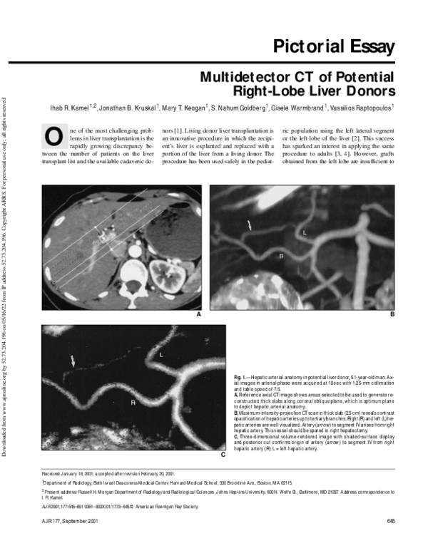 (PDF) Multidetector CT of Potential Right-Lobe Liver Donors