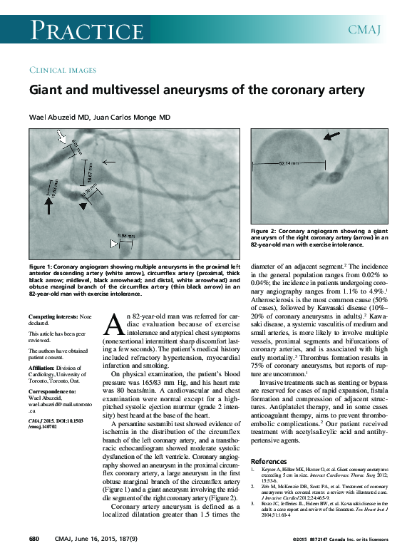 (PDF) Giant and multivessel aneurysms of the coronary artery