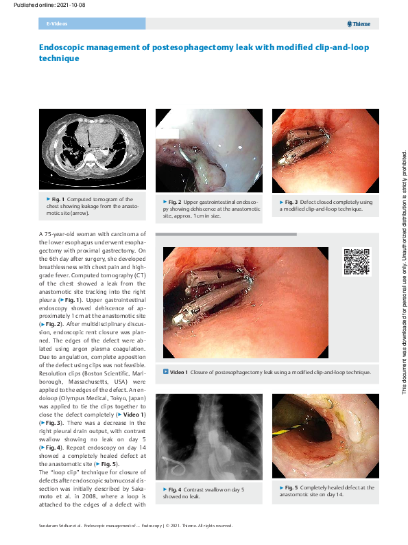(PDF) Endoscopic management of postesophagectomy leak with modified ...