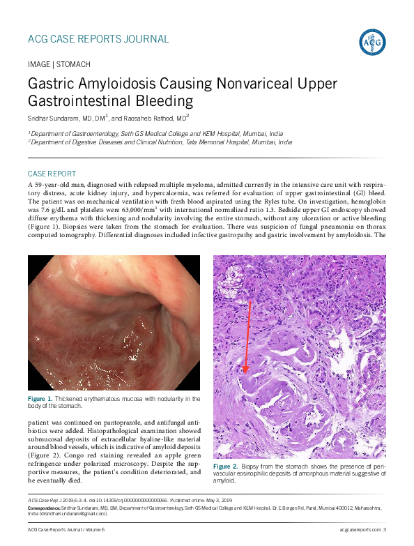 (PDF) Gastric Amyloidosis Causing Nonvariceal Upper Gastrointestinal ...