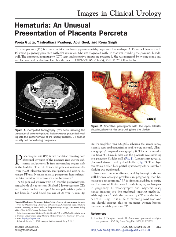 (PDF) Hematuria: An Unusual Presentation of Placenta Percreta | Pooja ...