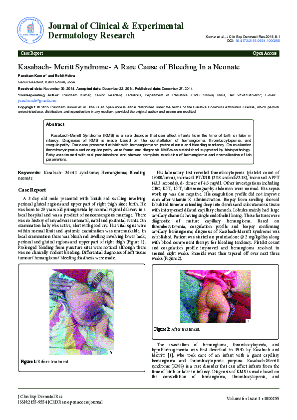 (PDF) Kasabach- Meritt Syndrome- A Rare Cause of Bleeding In a Neonate