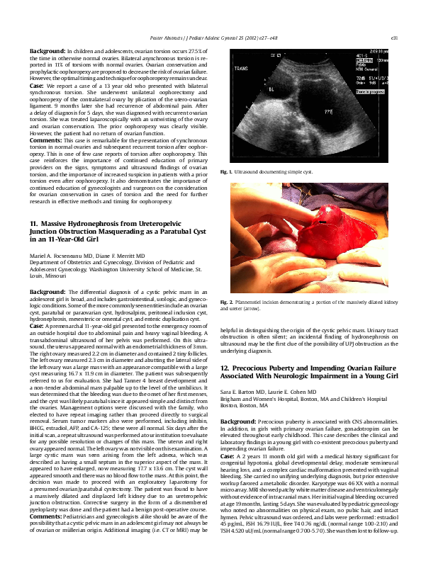 (PDF) Massive Hydronephrosis from Ureteropelvic Junction Obstruction ...