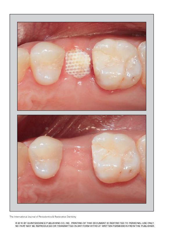 (PDF) Socket Preservation with d-PTFE Membrane: Histologic Analysis of ...