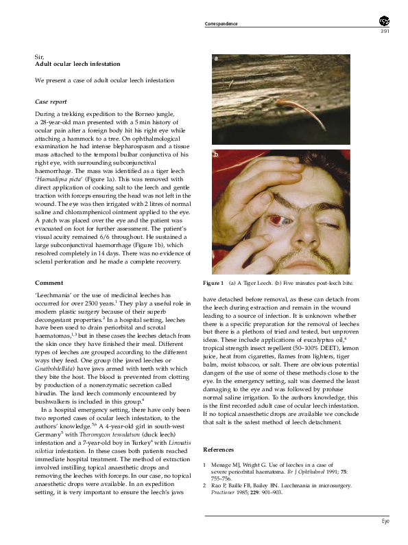 (PDF) Adult ocular leech infestation