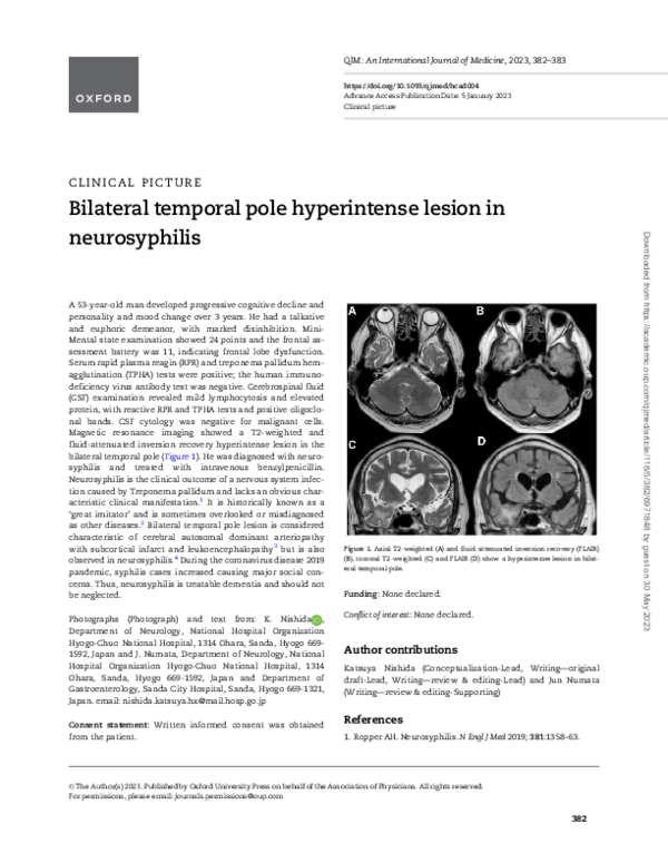 (PDF) Bilateral temporal pole hyperintense lesion in neurosyphilis