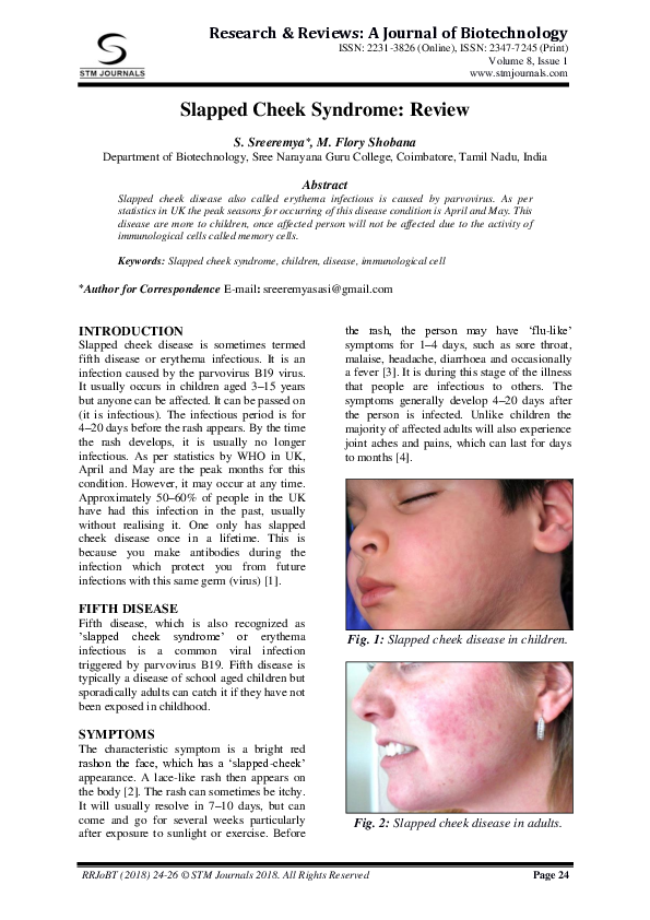 (PDF) Slapped Cheek Syndrome: Review