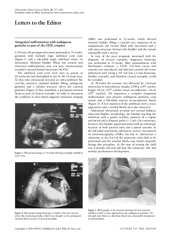 (PDF) Anogenital malformation with ambiguous genitalia as part of the OEIS complex | Ingrid ...