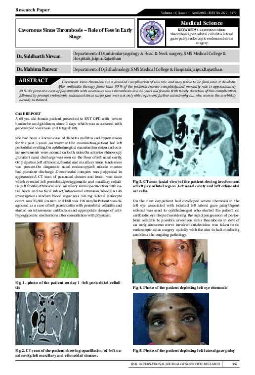 (PDF) Cavernous Sinus Thrombosis–Role of Fess in Early Stage