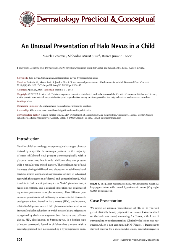 (PDF) An Unusual Presentation of Halo Nevus in a Child | Mikela ...
