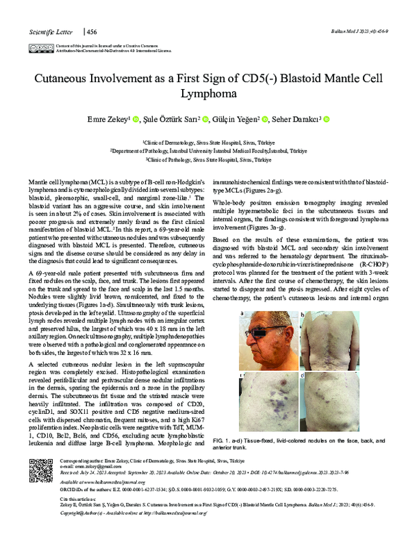 (PDF) Cutaneous Involvement as a First Sign of CD5(-) Blastoid Mantle ...