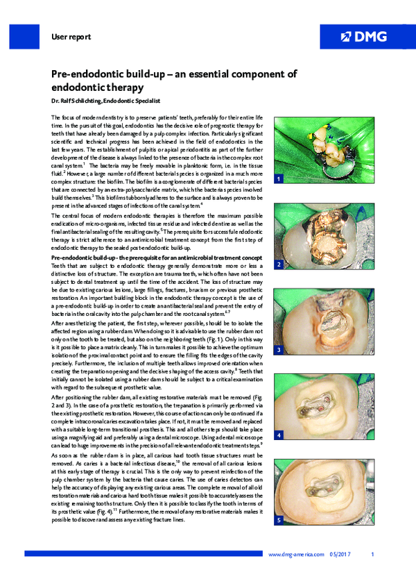 (PDF) Pre-endodontic build-up – an essential component of endodontic ...