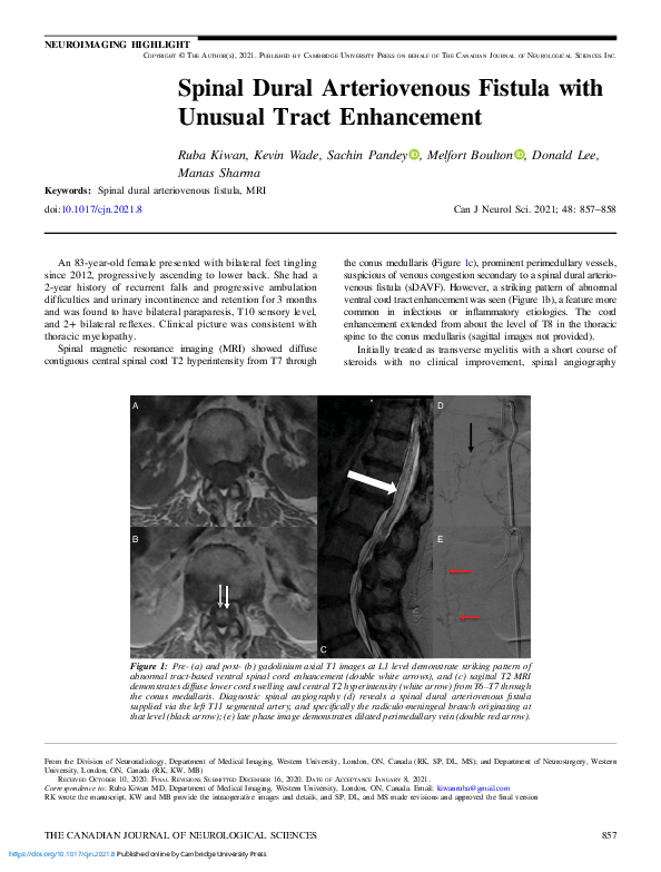 (PDF) Spinal Dural Arteriovenous Fistula with Unusual Tract Enhancement