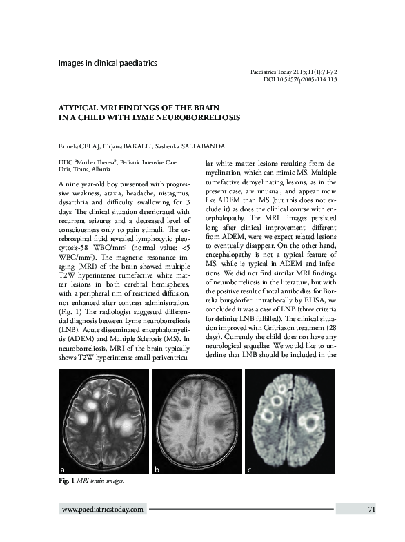 (PDF) Atypical Mri Findings of the Brain in a Child with Lyme ...