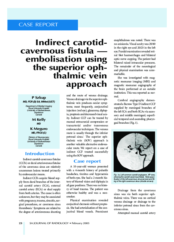 (PDF) Indirect carotid-cavernous fistula - embolisation using the ...