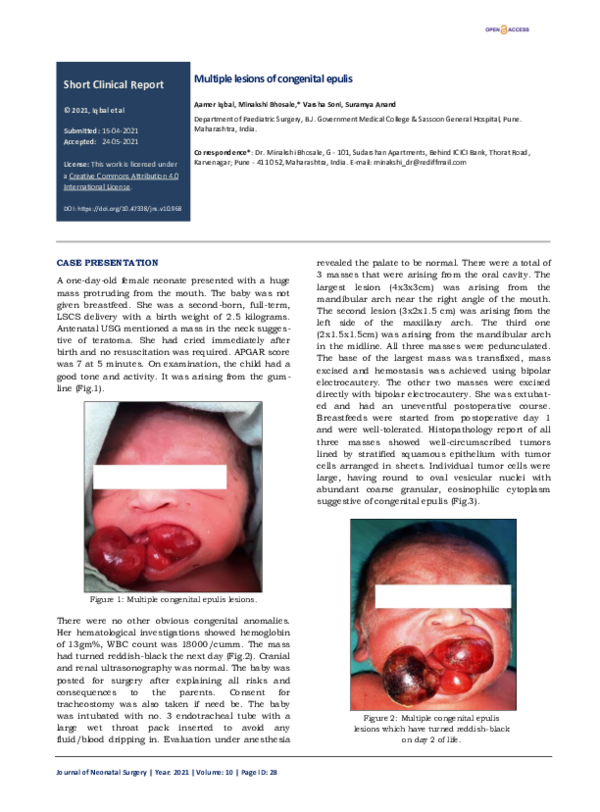 (PDF) Multiple lesions of congenital epulis
