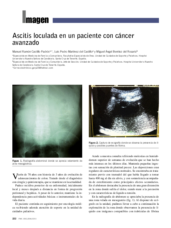 (PDF) Ascitis loculada en un paciente con cáncer avanzado