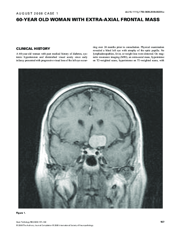 (PDF) 60-YEAR Old Woman with Extra-Axial Frontal Mass