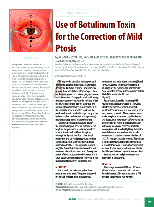 (PDF) Use of Botulinum Toxin for the Correction of Mild Ptosis