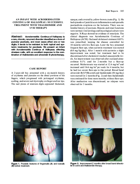 (PDF) An Infant with Acrodermatitis Continua of Hallopeau: Successful ...